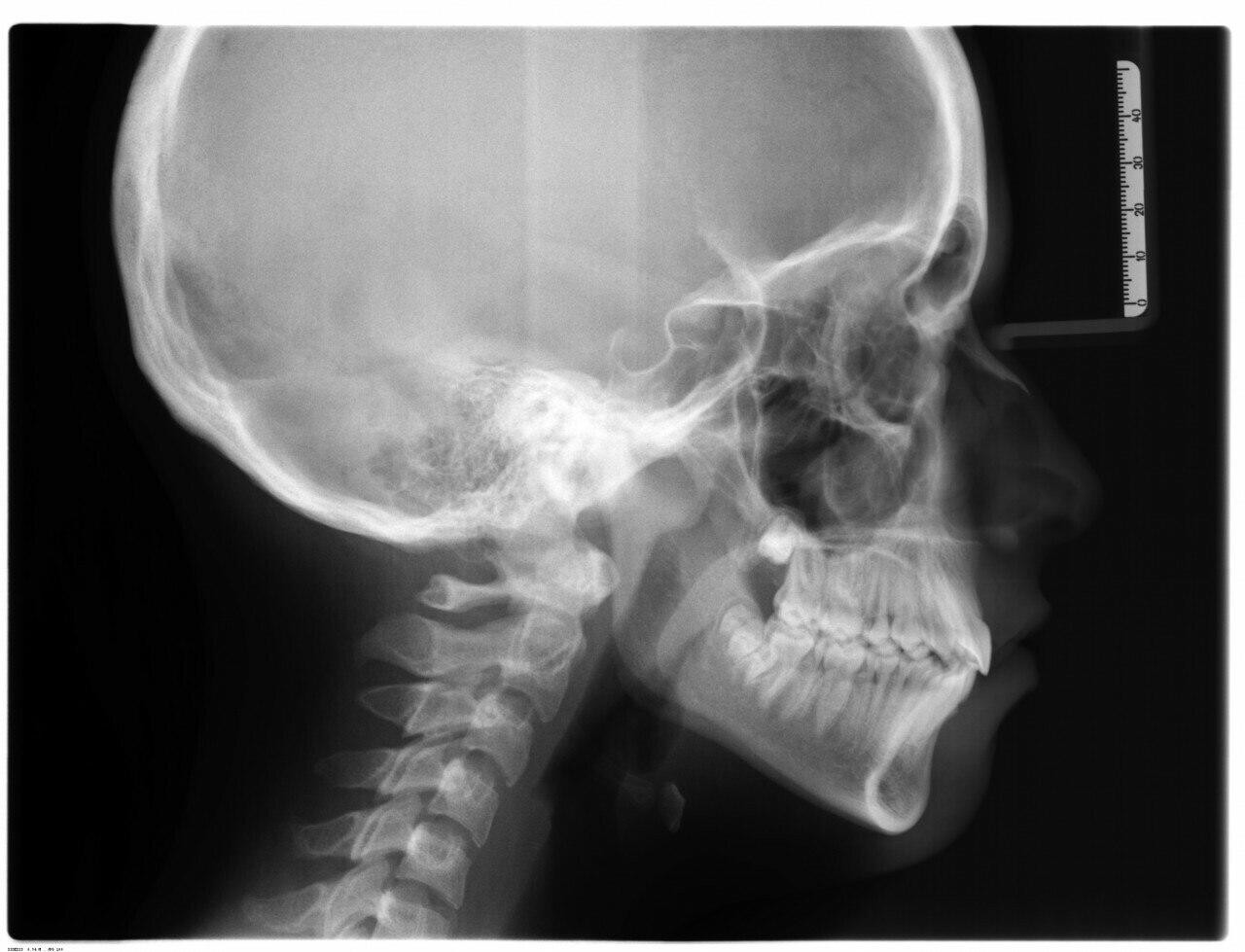 Sirona Orthophos XG 3D Panorex + CEPH + Cone Beam | Renew Digital