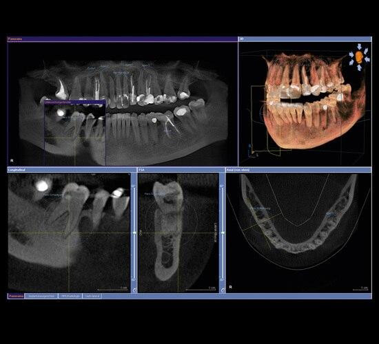 Sirona Orthophos XG 3D Panorex + CEPH + Cone Beam | Renew Digital