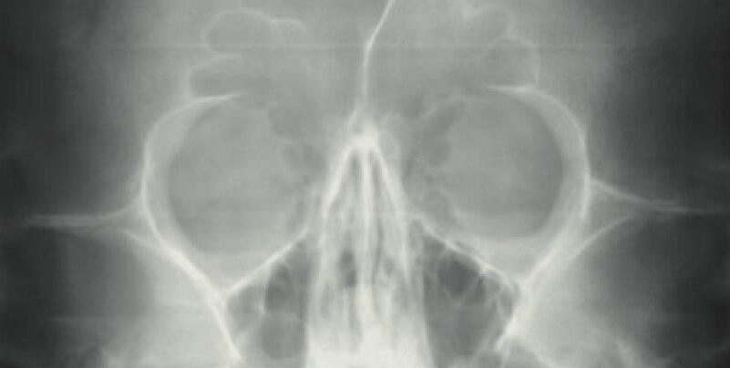 Sirona Orthophos XG 3D Panoramic + Cone Beam X-ray Machine | Renew Digital