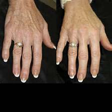 IPL Skin Pigmentation - Hands - Le Beau Clinic & Spa Perth