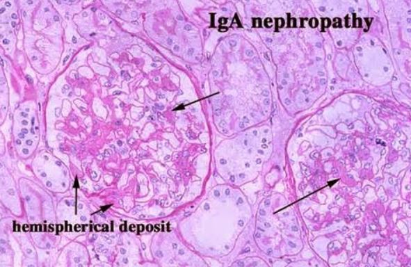 Galactose-deficient IgA1 (Gd-IgA1) as a Biomarker for IgA Nephropathy ...