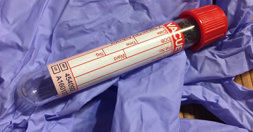 A Blood Test to Diagnose Concussions, Traumatic Brain Injuries - TheraSpecs