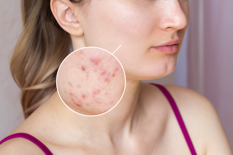 Acne Treatment: Get Rid of Pimples Permanently - NATURELOVA
