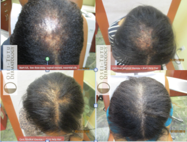 Central Centrifugal Cicatricial Alopecia (CCCA). What is CCCA? - Help Hair