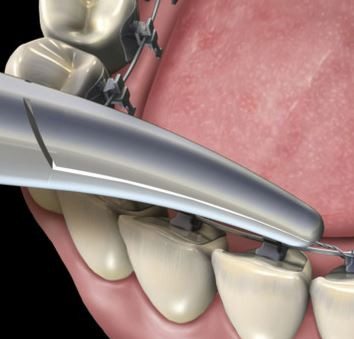Hu-Friedy Orthodontic Lingual Appliance Instrument