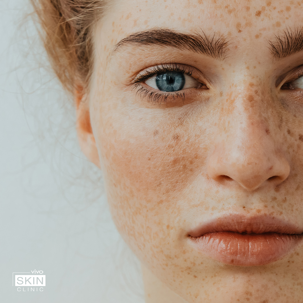 HYPERPIGMENTATION: What is it, and how can we treat it? - Vivo Hair ...