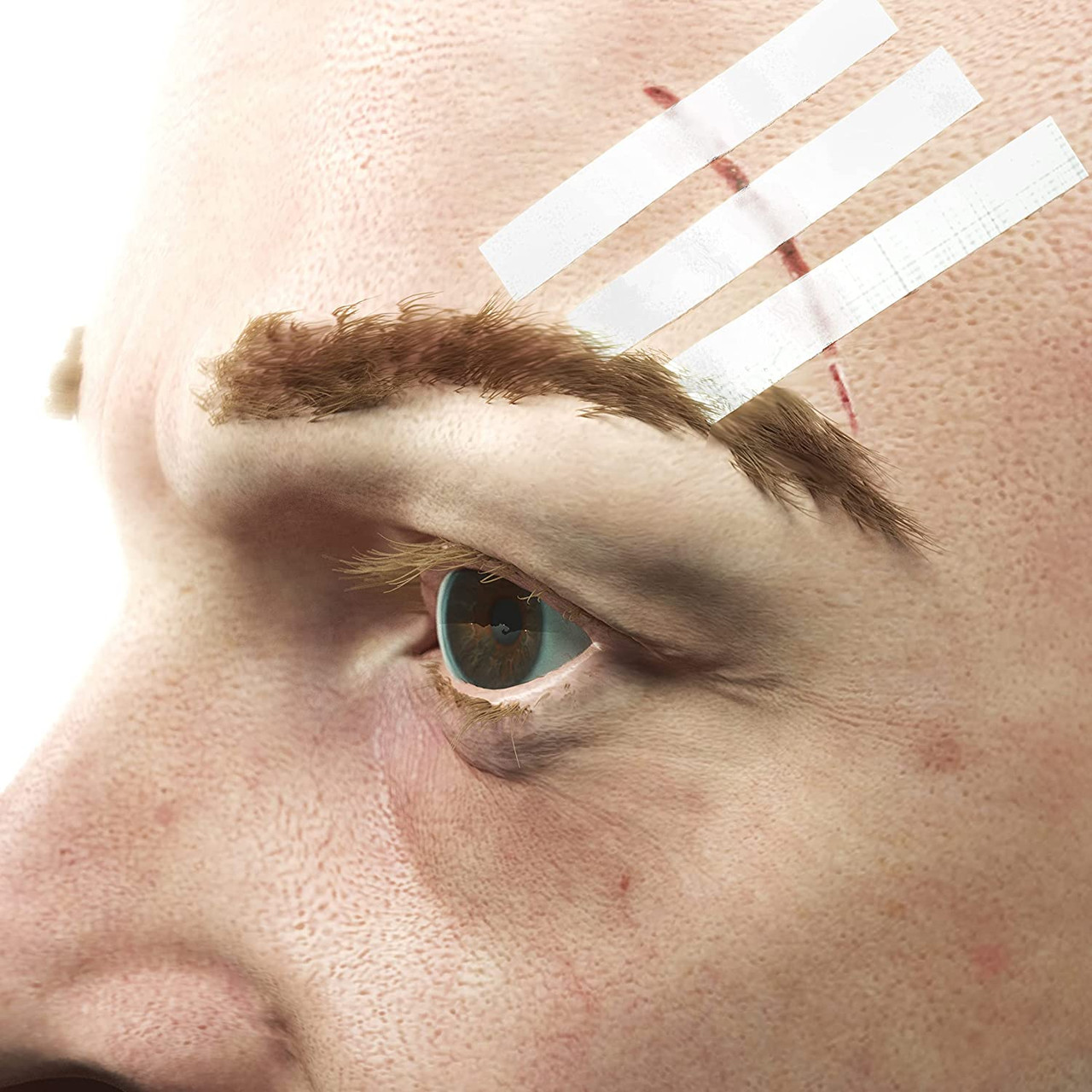 Wound Care - Wound Closure - MedicalDressings