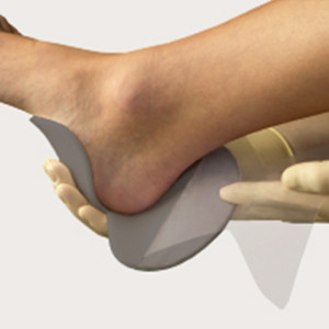 Mepilex Ag Antimicrobial Dressing | Medical Dressings