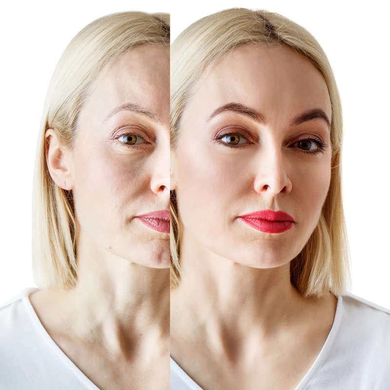 New Peel TCA - 35% Refine, Tighten & Lift | Facial Treatment | Jolie ...