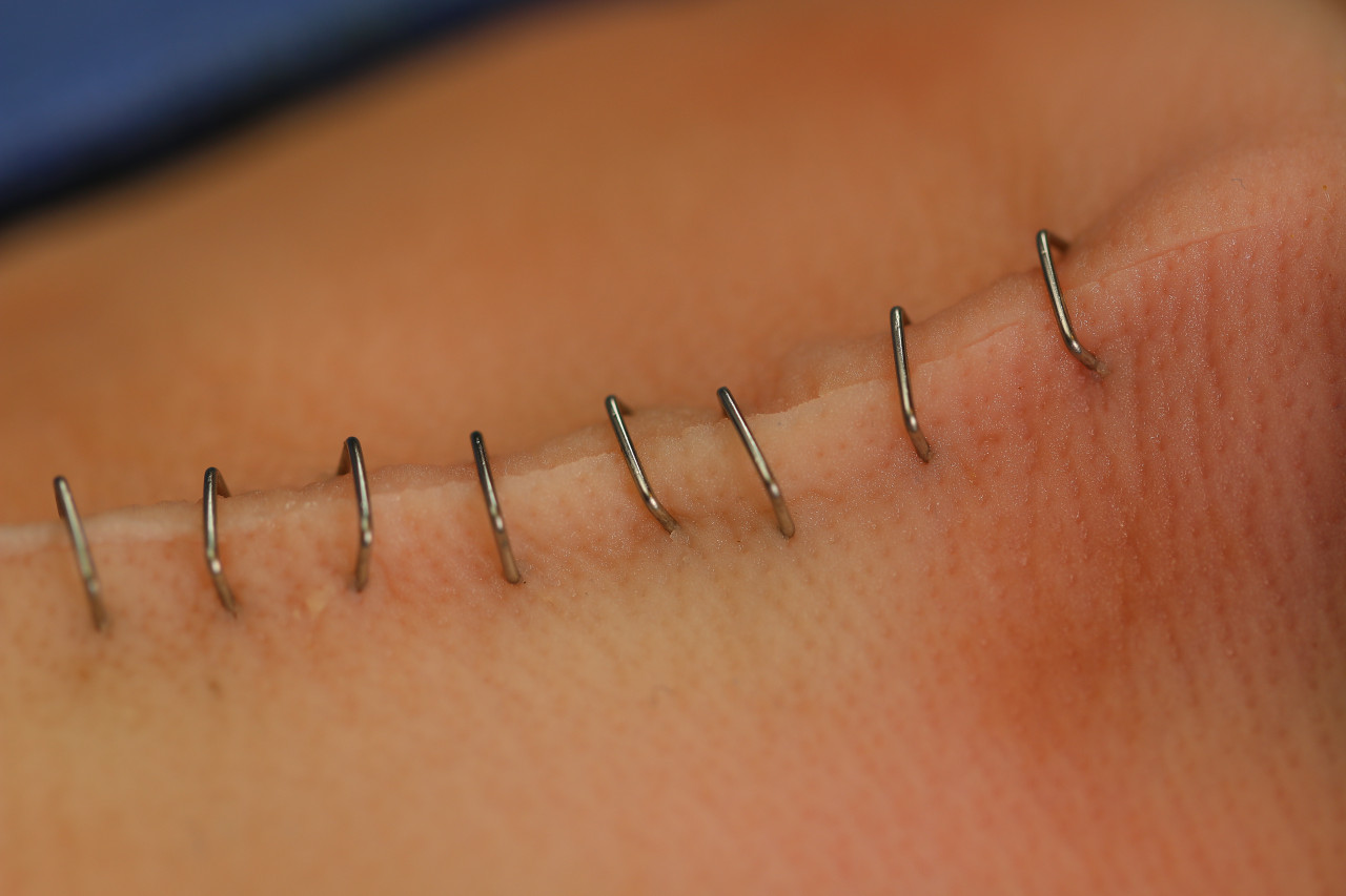 Suture and Staple Kit| Wound Survival First Aid Kit | Prepper Wound Kit ...