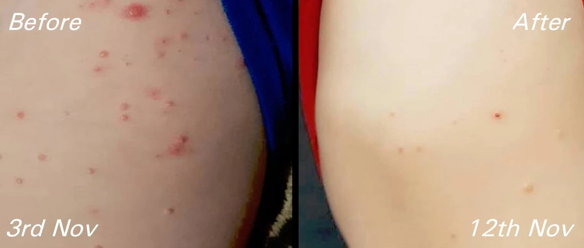 Mollenol for better skin. Mollenol Sensitive and Hydrocolloid Patches.