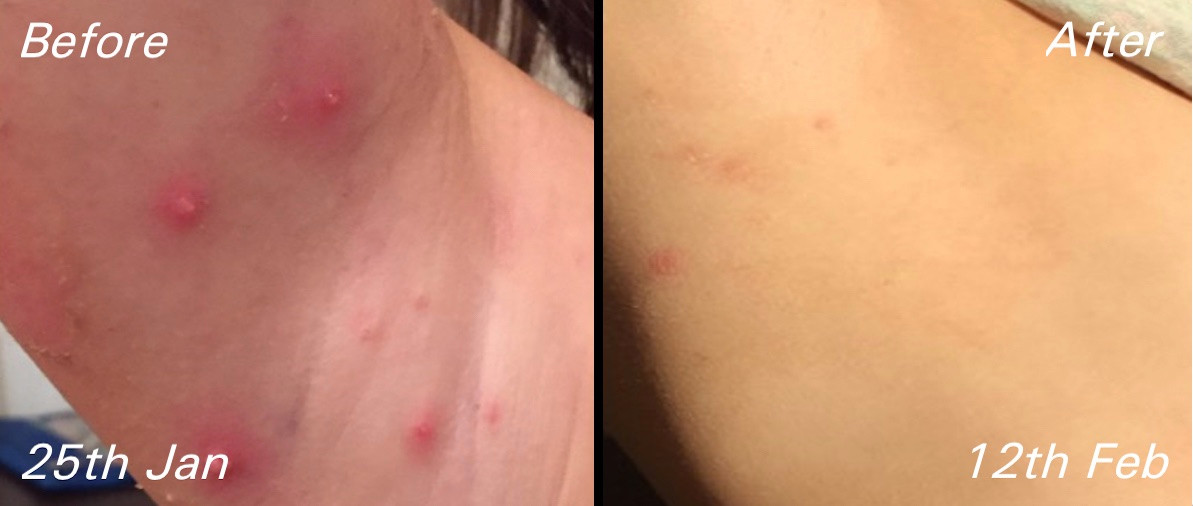 Mollenol for better skin. Mollenol Sensitive and Hydrocolloid Patches.