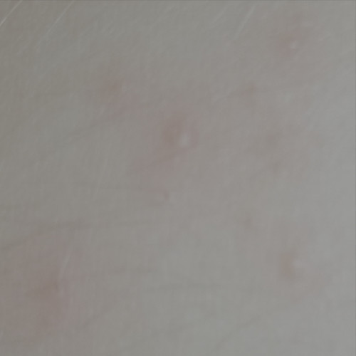 Mollenol for better skin. Mollenol Sensitive and Hydrocolloid Patches.