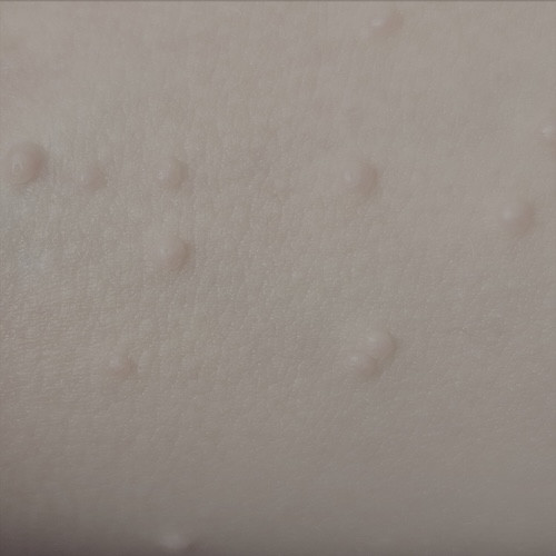 Mollenol for better skin. Mollenol Sensitive and Hydrocolloid Patches.