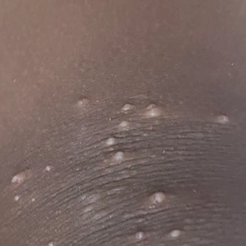 Mollenol for better skin
