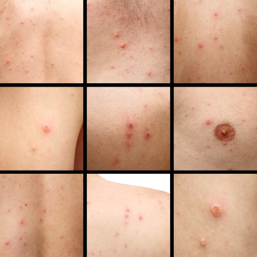 Mollenol for better skin. Mollenol Sensitive and Hydrocolloid Patches.