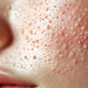 Mollenol for better skin. Mollenol Sensitive and Hydrocolloid Patches.
