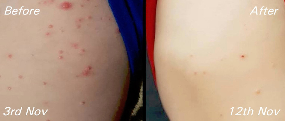 Mollenol for better skin. Mollenol Sensitive and Hydrocolloid Patches.
