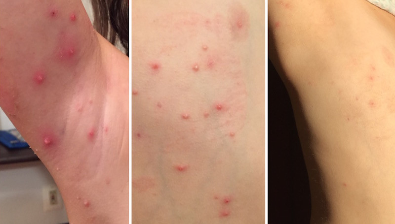 Mollenol for better skin