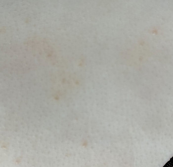 Mollenol for better skin. Mollenol Sensitive and Hydrocolloid Patches.