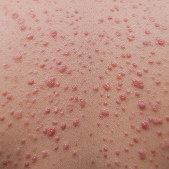 Spot The Differences: Molluscum Contagiosum Vs Chickenpox - Mollenol