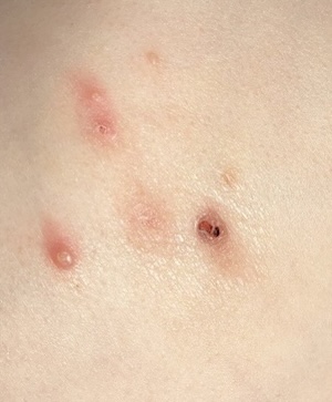 How to Get Rid of Molluscum: Medical & Home Treatments - Mollenol