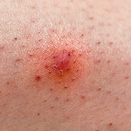 How to Treat Ingrown Hair: At-Home Steps & When to Get Help - Mollenol