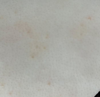 Understanding the Molluscum Contagiosum Incubation Period - Mollenol