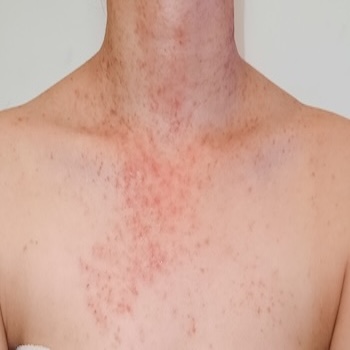 Bacterial Folliculitis Causes: Key Bacteria & Risk Factors - Mollenol