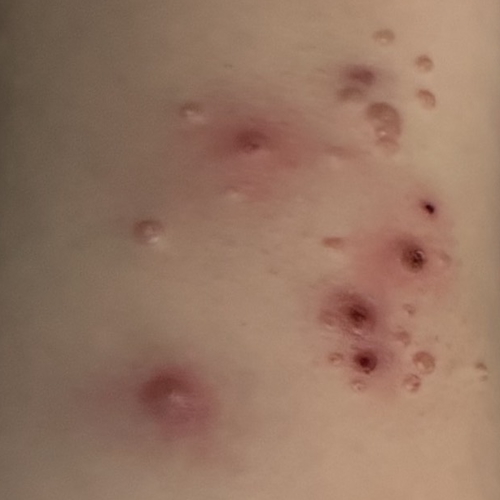 Molluscum Inflammation: Understanding Good vs. Bad Signs - Mollenol