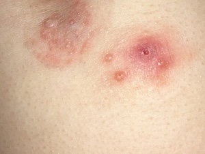 About Molluscum: What is molluscum contagiosum? - Mollenol
