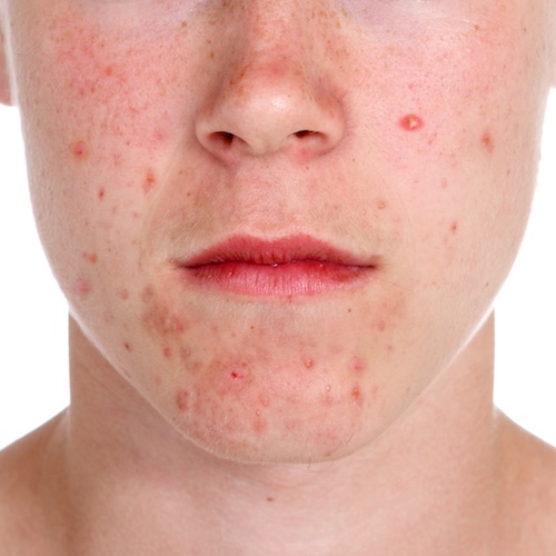 What Causes Pimples? Triggers, Types, Treatment, Prevention - Mollenol