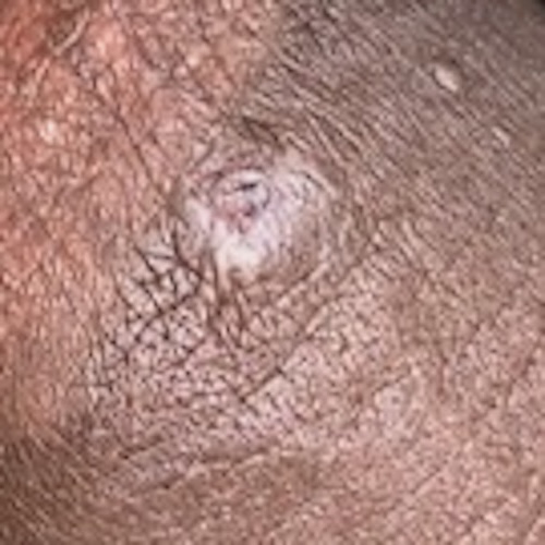 Mollenol and Adult Molluscum Contagiosum - Mollenol