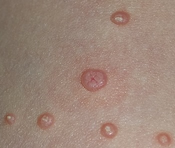 Mollenol and Natural Remedies for Molluscum Contagiosum - Mollenol