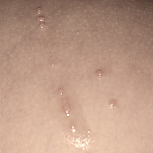 Are Molluscum Itchy? What to Know and How to Find Relief - Mollenol