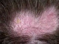 A COMMON SKIN CONDITION THAT CAUSES HAIR LOSS - Body4Real