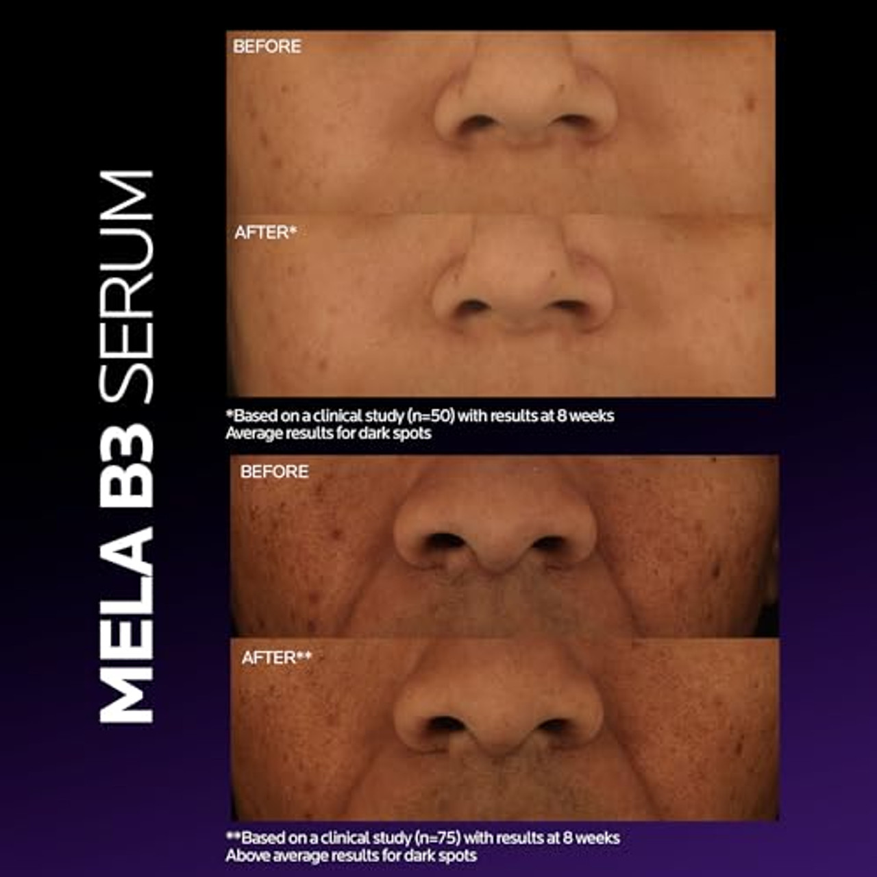 La Roche-Posay Mela B3 Serum 1 fl oz | Skin Elite