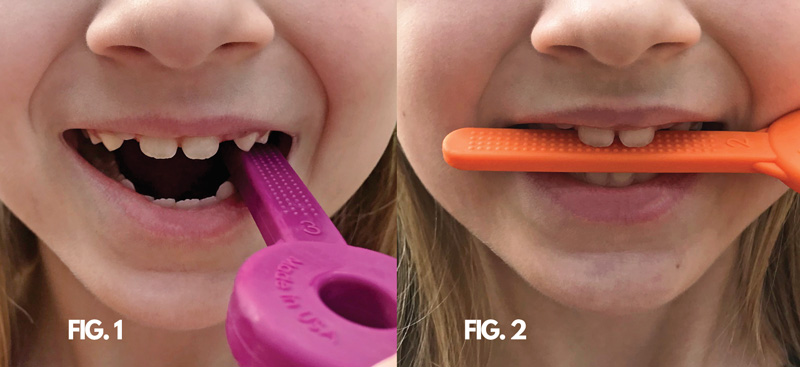 Jaw Grading Oral Motor Exercises with ARK's Bite Blocks - ARK Products, LLC