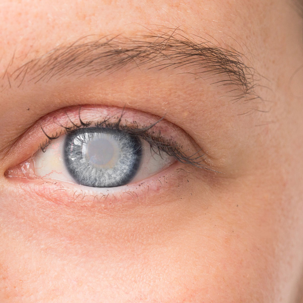 Treatment for Congenital Cataracts - Kids Eye Gear