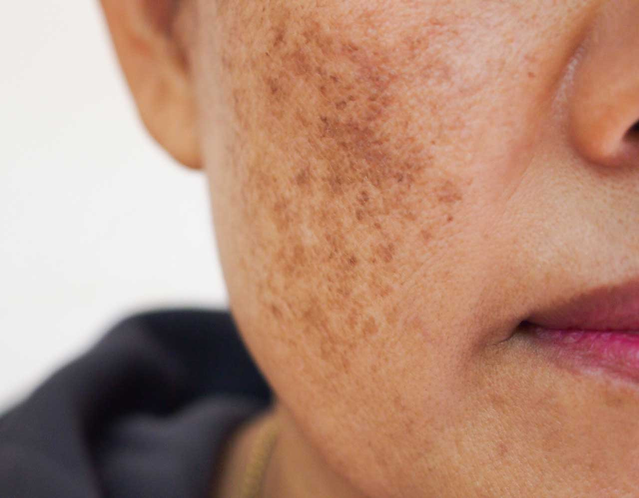 Hyperpigmentation: types, causes and treatments - Dr. Barbara Sturm - UK