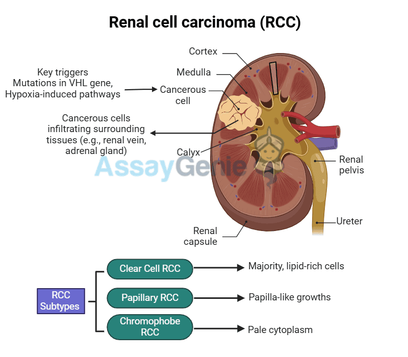 Renal Cell Carcinoma: Understanding, Diagnosing, and Treating Kidney ...