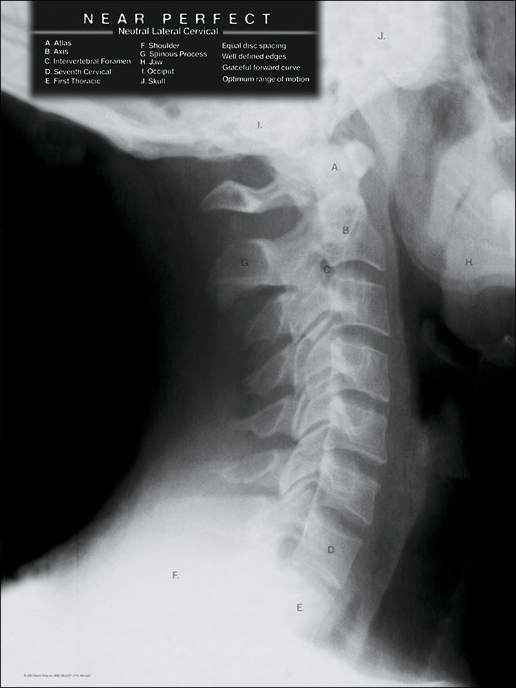 Normal Neck X-ray | Textbook Cervical Spine X-ray Poster