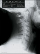 Normal Neck X-ray | Textbook Cervical Spine X-ray Poster