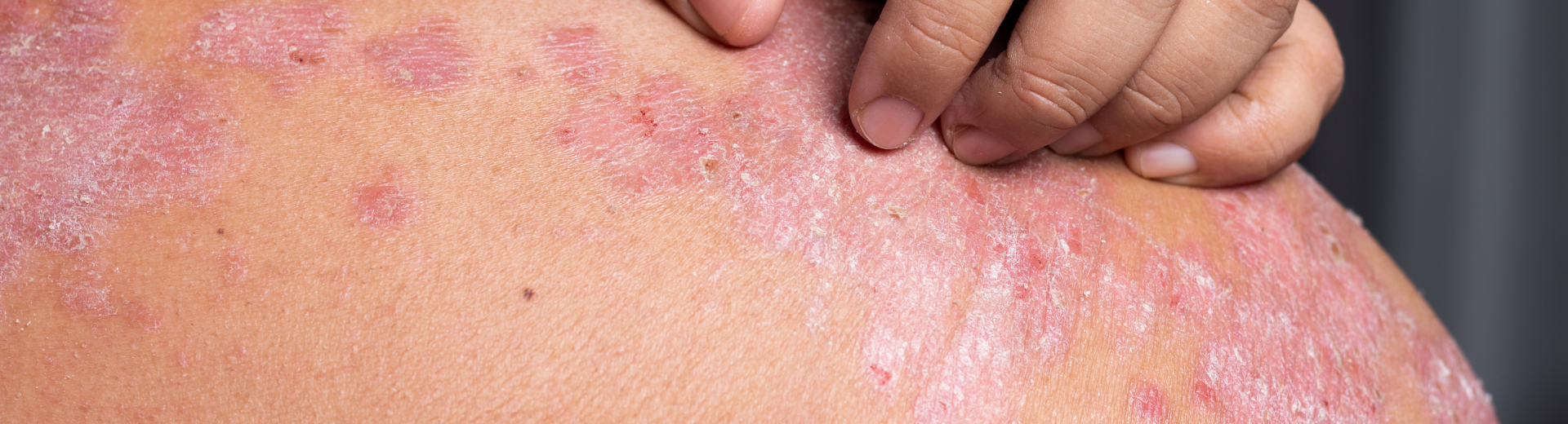 Giornata della Psoriasi: Miti da Sfatare e Verità da Conoscere ...