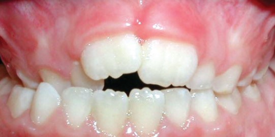 Crossbite in Kids: What It Is – and How Myo Munchee Helps - Myo Munchee ...