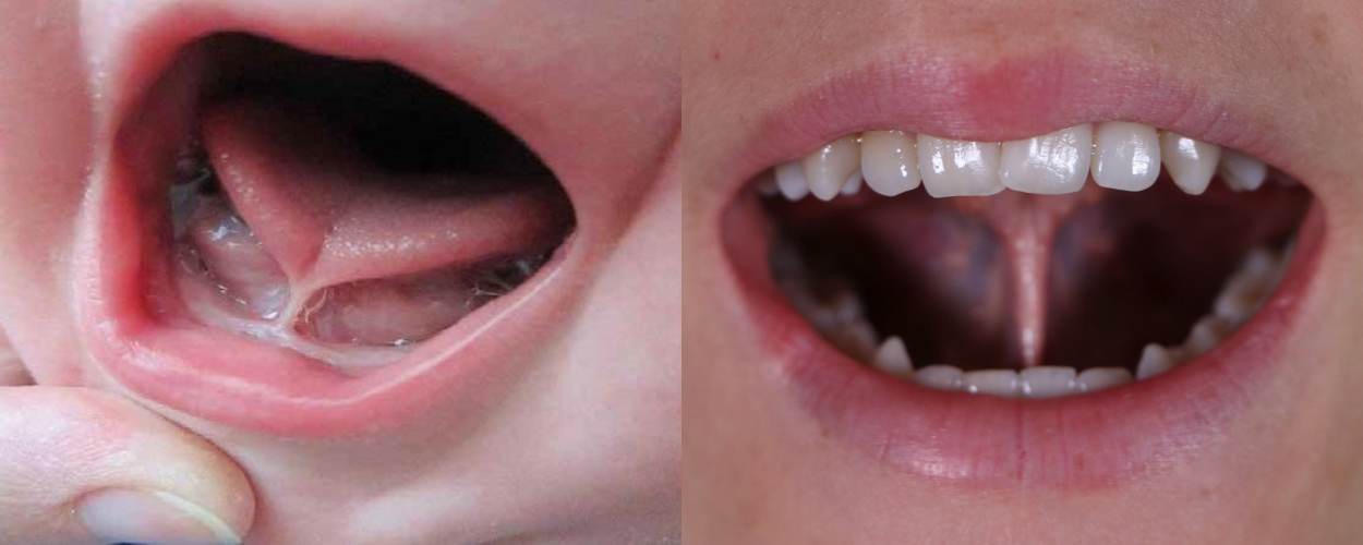 Ankyloglossia (Tongue Tie) and Oral Development - Myo Munchee ...