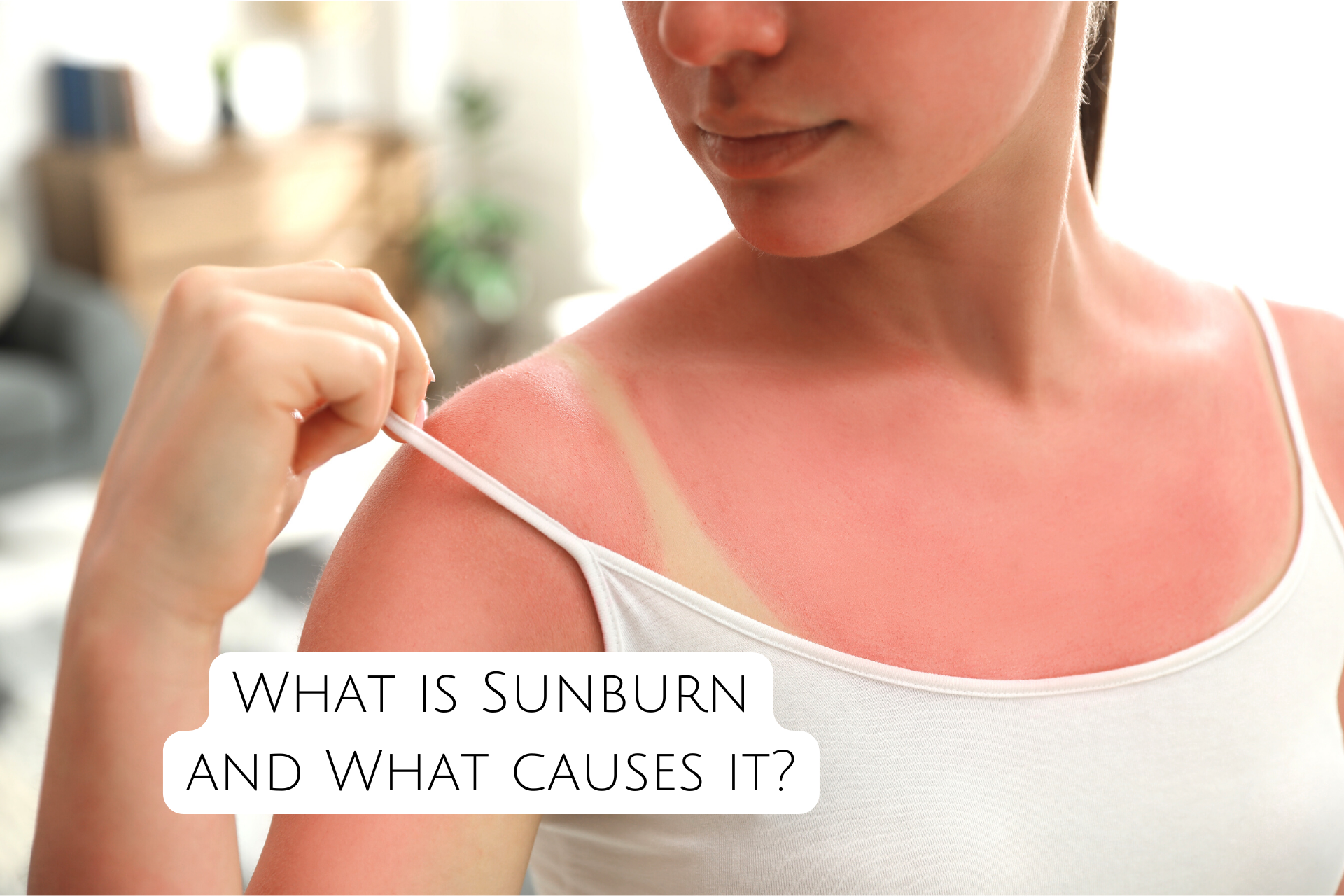 What is Sunburn and What causes it? - Kiwla