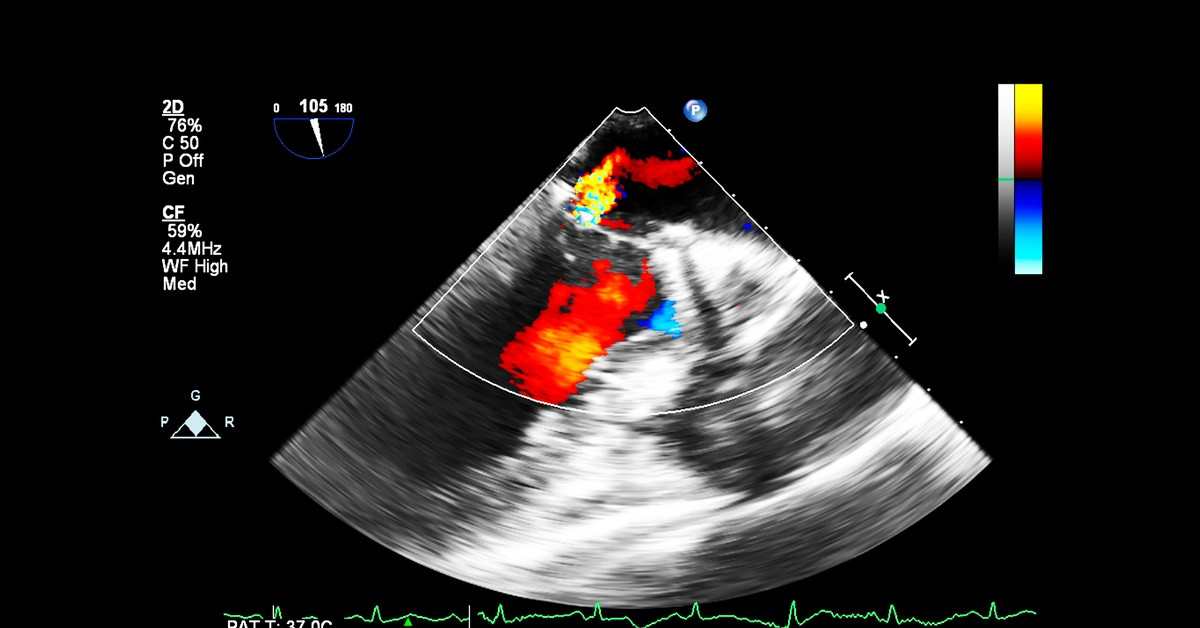 What Is a Transcranial Doppler (TCD) Ultrasound? - Cascade Health Care Inc.
