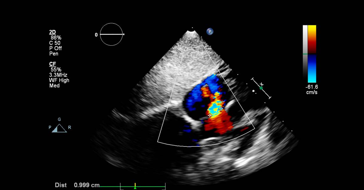 The Differences Between Color Doppler and Power Doppler - Cascade ...