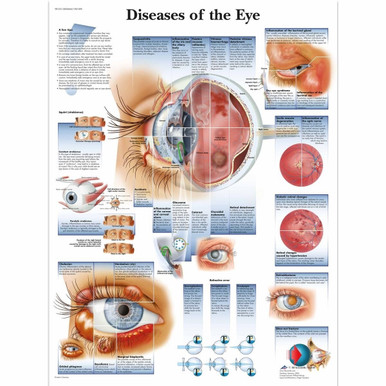 Diseases of the Eye Wall Chart, 3B Scientific No Sales Tax Cascade ...